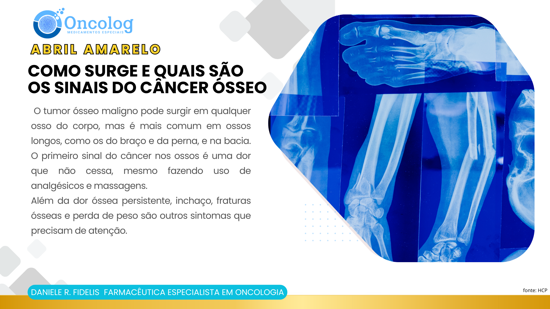 Como surge e quais são os sinais do câncer ósseo? - Oncolog ...